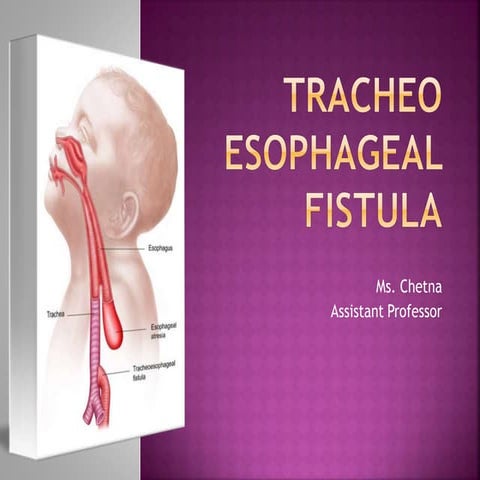 tracheo-oesophagealfistula | PPT