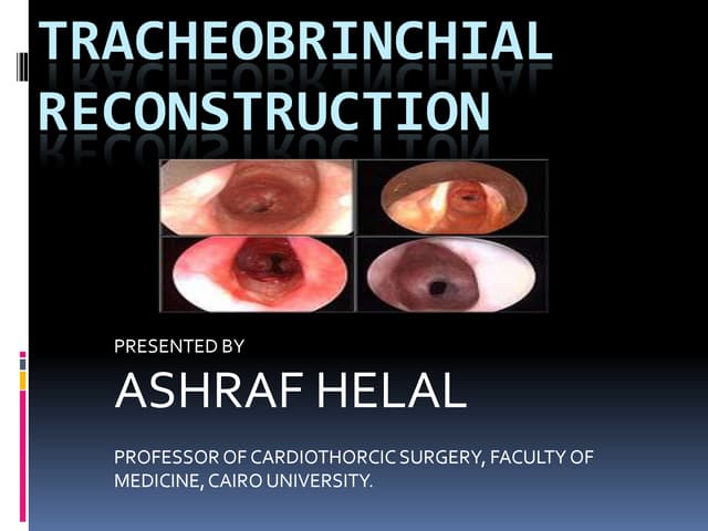 STOMAL RECURRENCE AFTER LARYNGECTOMY-1.pptx