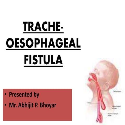 Tracheoesophageal Fistula Classification