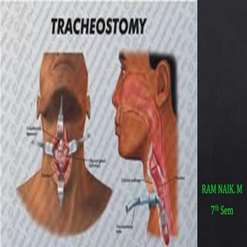 Tracheostomy | PPT