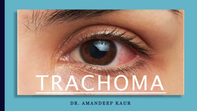 Trachoma | PPTX | Eye and Vision Conditions | Diseases and Conditions