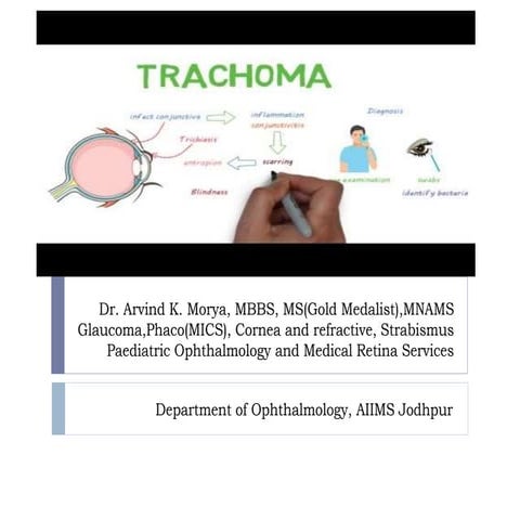 TRACHOMA- DIAGNOSIS AND MANAGEMENT | PPTX