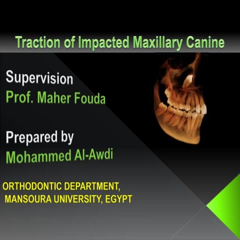 orthodonticTraction of impacted maxillary canine and Piggyback ...