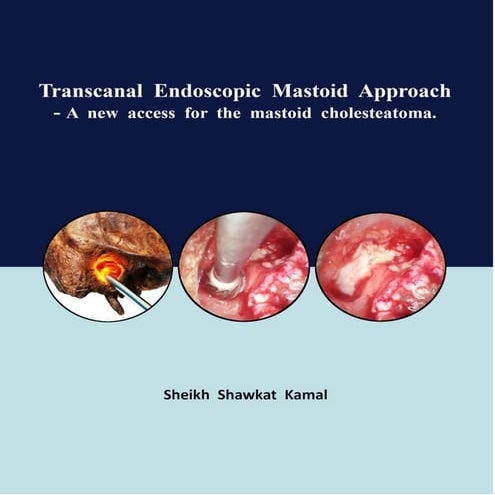 Transcanal Endoscopic Mastoid Approach- A new access for the mastoid ...