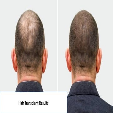 Hair Transplant Before And After | PDF