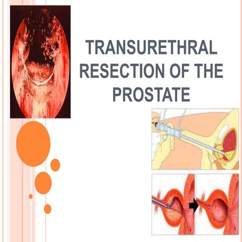 Nursing Transurethral Resection of the Prostate | PPTX