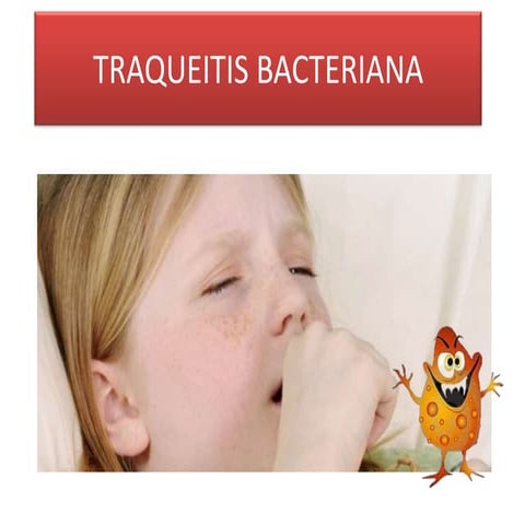 Derrame pleural pediatria