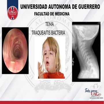 TRAQUITIS Y LARINGOTRAQUITIS--SUBIR.pptx