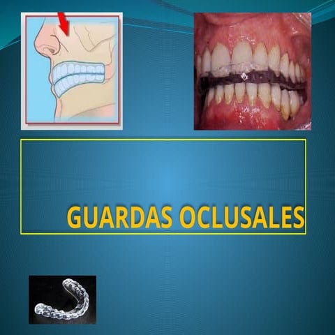 Guardas oclusales denisse amaro delgado | PDF