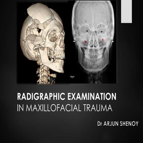 Imaging Of Facial Trauma Part 1