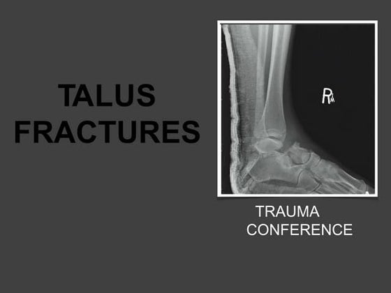 200421 Fractures of the talus | PPTX