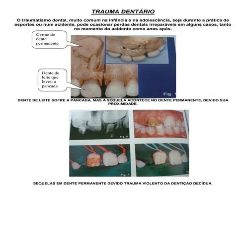 traumadentrio-130911090425-phpapp01.pdf