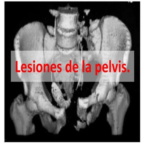 Trauma lesiones de la pelvis | PPTX