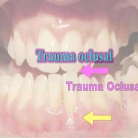 Trauma oclusal | PPTX