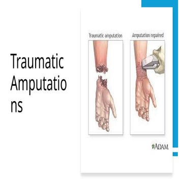 Traumatic Amputations (1).orthopaedic carepptx | PPT