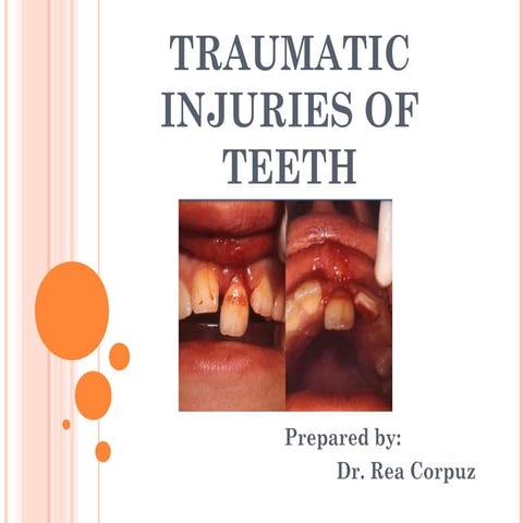Traumatic injuries of teeth | PPT