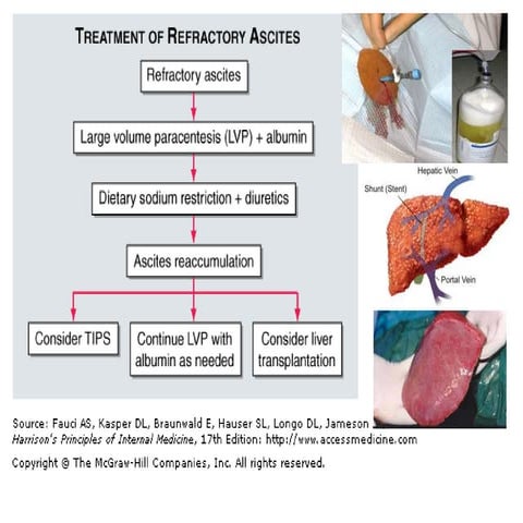 Treatment of refractory ascites | PPTX