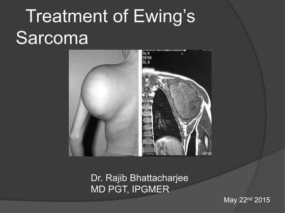 Ewings sarcoma | PPT