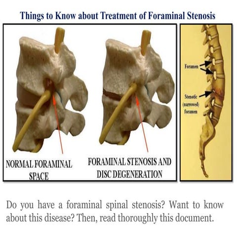 Treatment of foraminal stenosis | PPTX