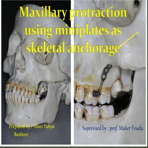 Treatment of maxillary deficiency by miniplates last | PPTX | Dental ...