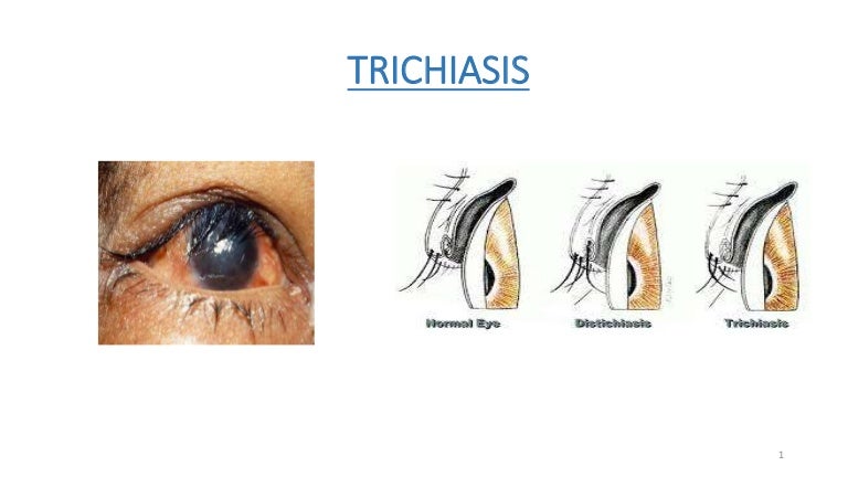 Trichiasis
