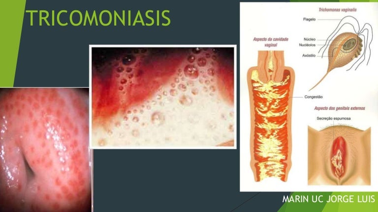 TRICOMONIASIS