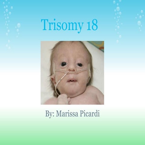Trisomy 18 | PPT | Pregnancy | Reproductive Health