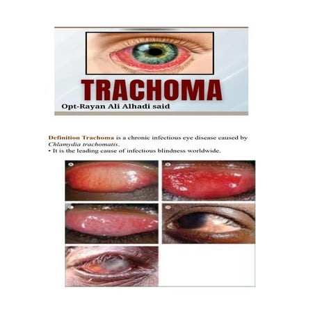 Trochoma , definition , Etiology and treatment.PDF