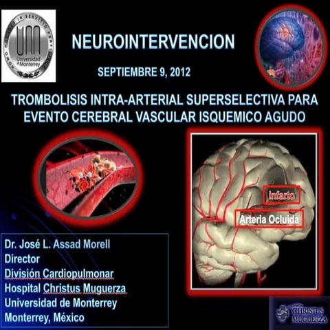 TROMBOLISIS INTRA-ARTERIAL EN EVENTO CEREBRAL VASCULAR ISQUEMICO AGUDO ...