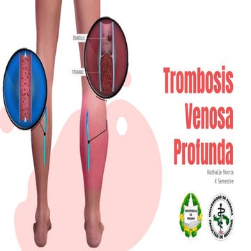 Clasificacion Ceap para varices | PPTX