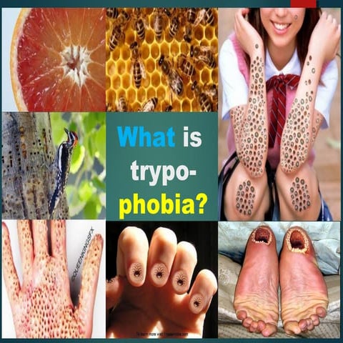 Holes In Skin Disease Trypophobia