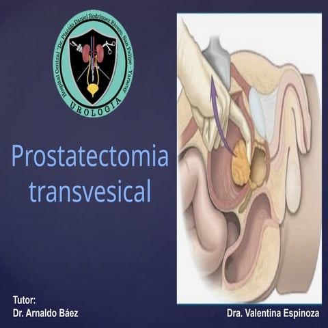 Comprehensive Overview of Transvesical Prostatectomy Surgical Procedure ...