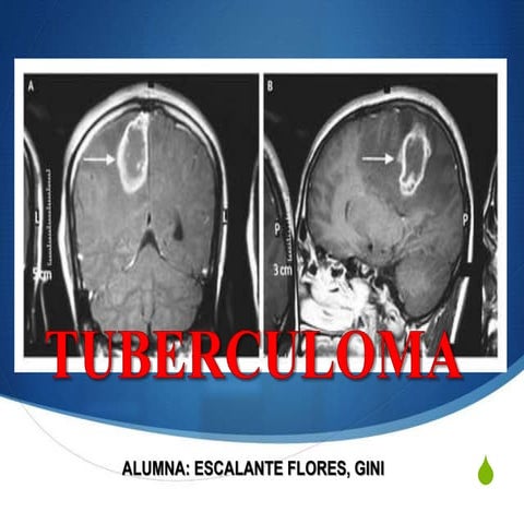 Tuberculoma | PPTX