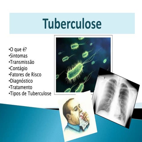 Tuberculose | PPTX