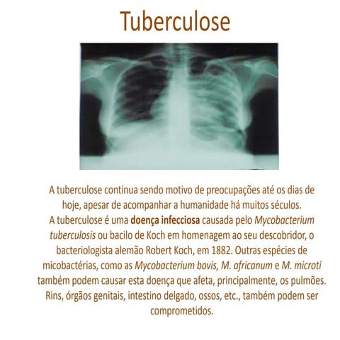 Tuberculose | PPTX