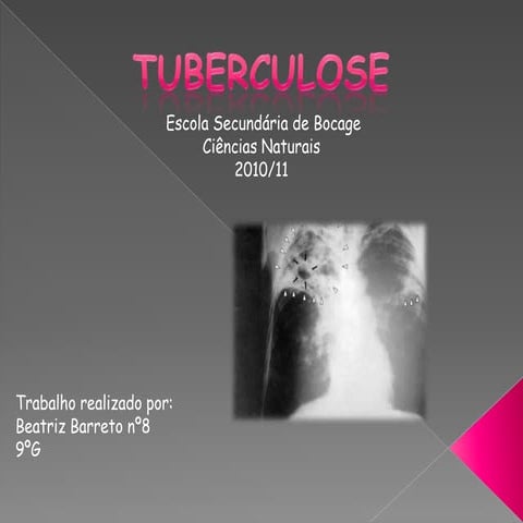 Tuberculose | PPTX