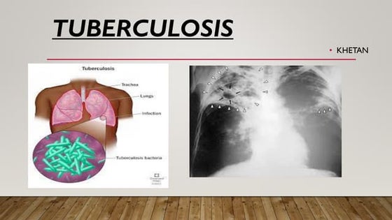 Tuberculosis by Vinita Joshi, G.S.K.V sec-16 rohini (1413070).pptx
