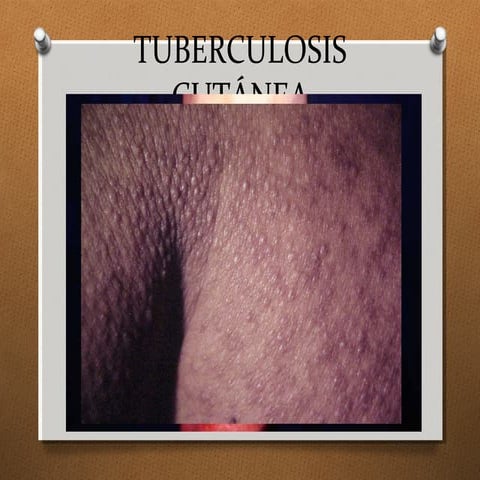 Tuberculosis Cutanea Ppt