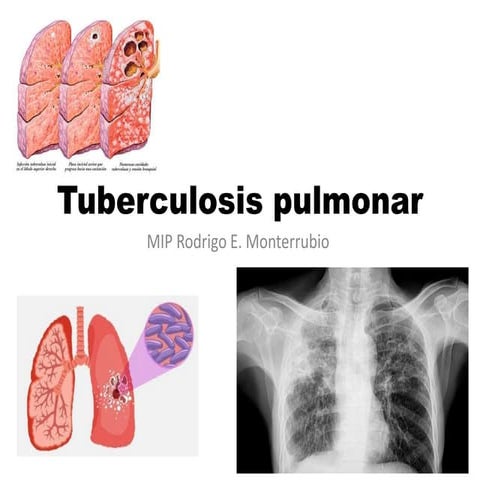 Tuberculosis Pulmonar O Pulmonar: Causas, Síntomas, Tipos – YGGD