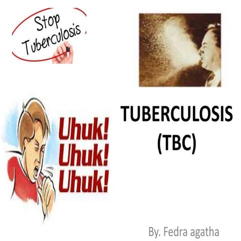 FedraagathamateriTUBERCULOSIS (TBC).pptx