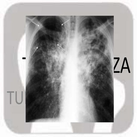 Tuberkuloza-Tuberculosis | PPTX