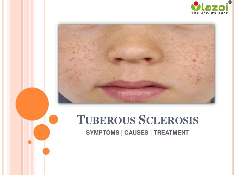 Tuberous Sclerosis : Causes, Symptoms, Diagnosis, Prevention and Trea…