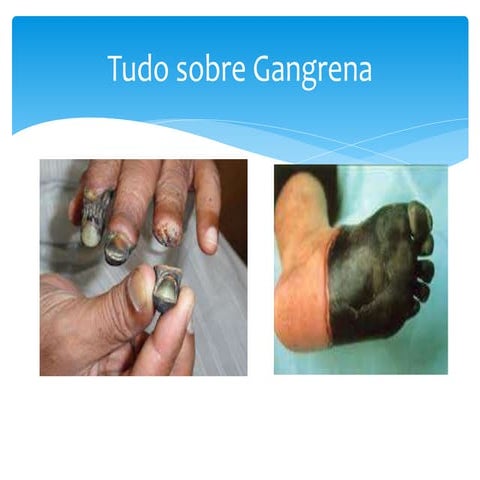 Tudo sobre Gangrena: Causas, Sintomas e Tratamento | PPT