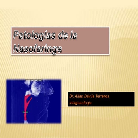 Tumores de la nasofaringe | PPTX