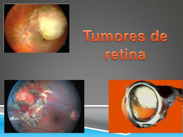 Tumores de retina