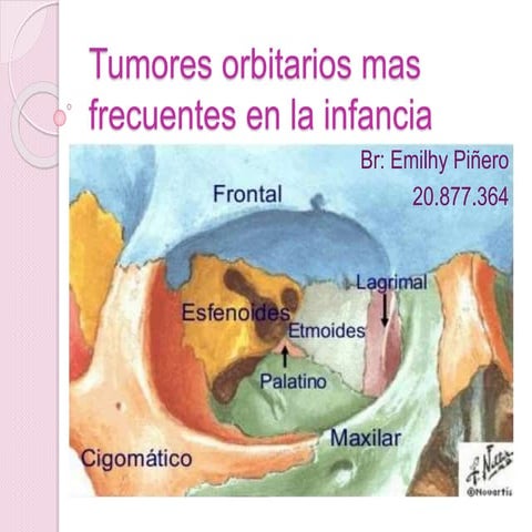 Tumores orbitarios mas frecuentes en la infancia | PPTX