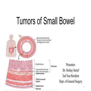 Tumors of small bowel.pptx