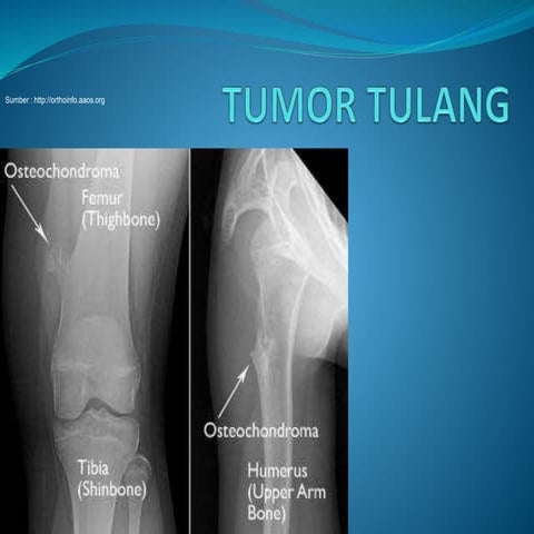 Tumor tulang shb | PPTX