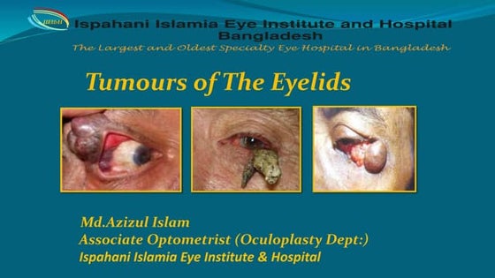 Simple & Toric Transposition | PPTX | Eye and Vision Conditions ...