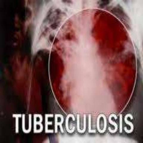 Turbekulozi Pulmonar! | PPTX